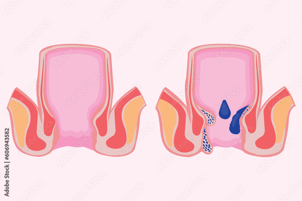 Stock-Vektorgrafik „piles. hemorrhoidal disease. comparison and ...