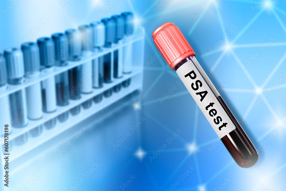 Stock-Foto „PSA test. Test tube with blood. Serology and hematology ...