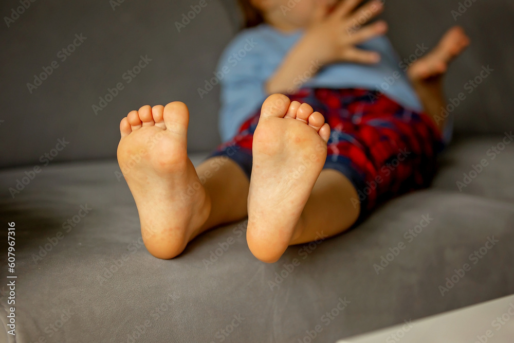 Stockfoto Child with skin rash, roseola. Hand-foot-and-mouth disease ...