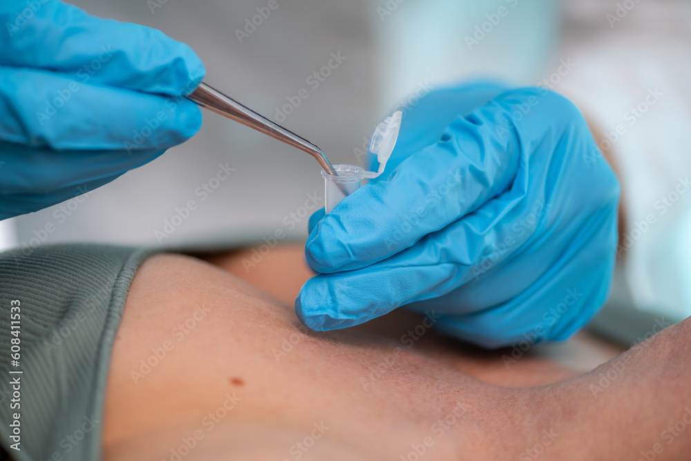 Examination of Skin Lesions. Dermatologist Uncovering Insights for ...