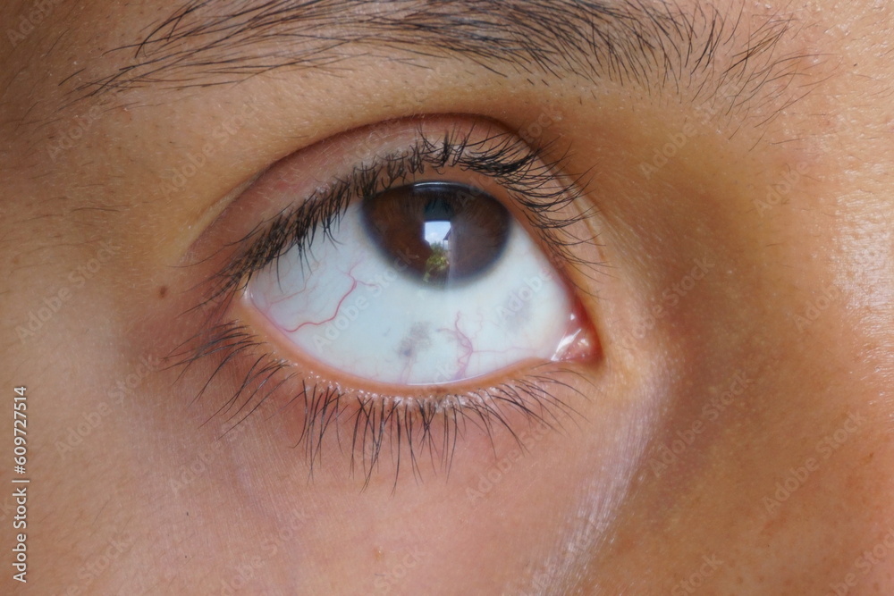 Grey spots in the white part of the eye of a girl, Ocular Melanosis ...