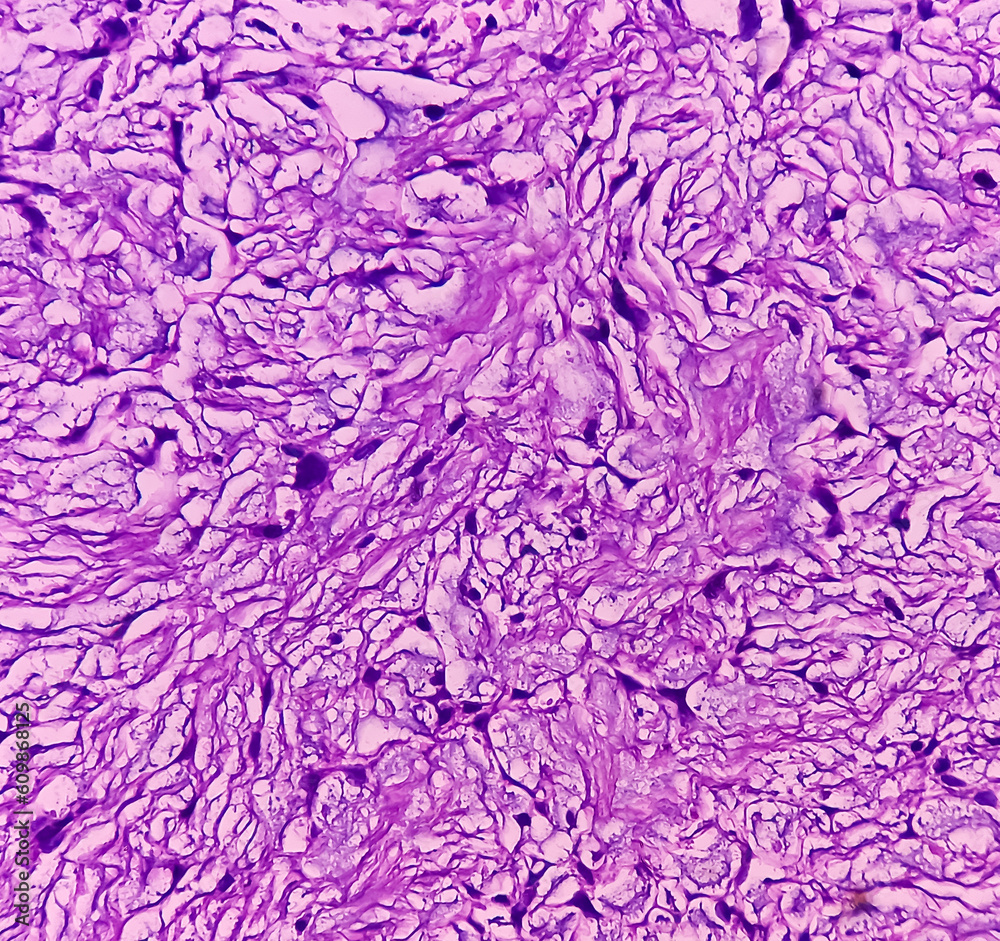 Salivary mucoid cyst. microscopic show parotid tissue, features of cyst ...