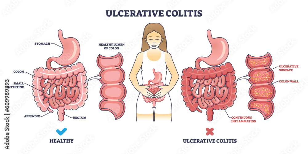Ulcerative colitis as chronic inflammatory bowel disease outline ...