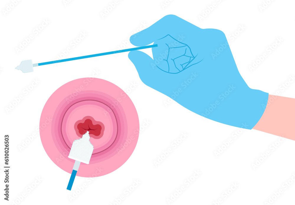 examine in women Obstetric swab with vulvar warts prevent by Pap smear ...