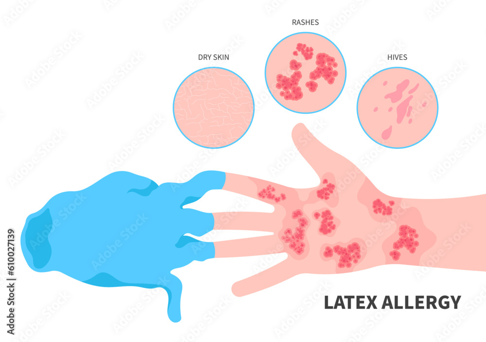 Vector de Stock chemical exposure latex allergy the allergic itching ...