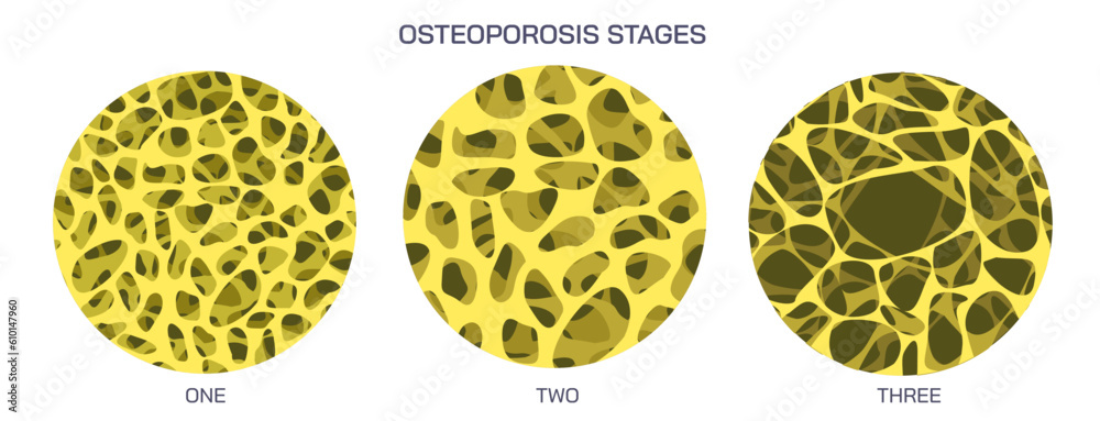 Bone density measurements and stages of osteoporosis. A bone disease ...