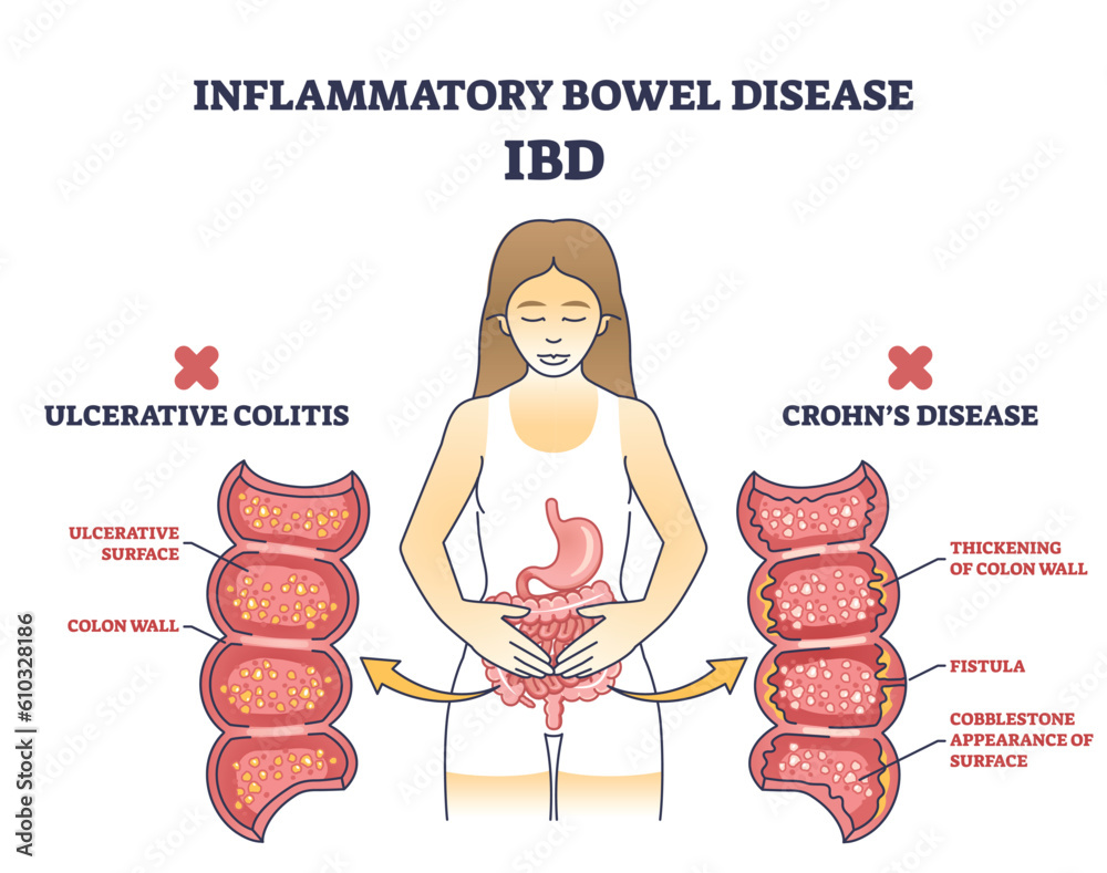 Inflammatory bowel disease or IBD with Crohns condition and ulcerative ...