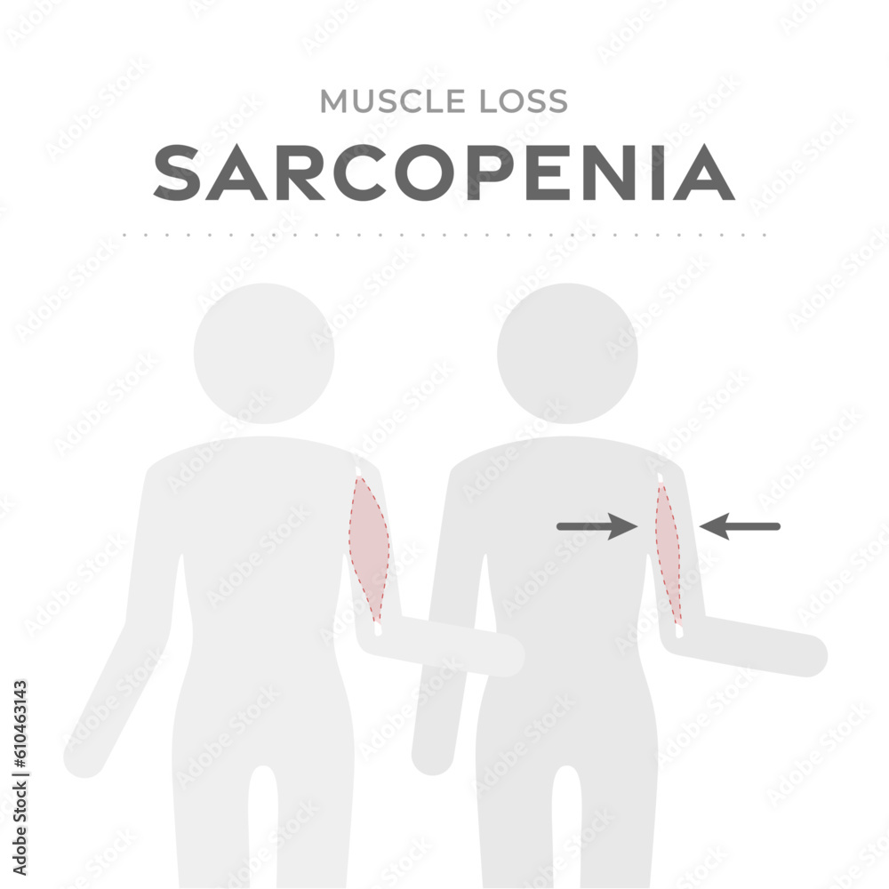 Sarcopenia, muscle loss medical scheme. Vector illustration with human ...
