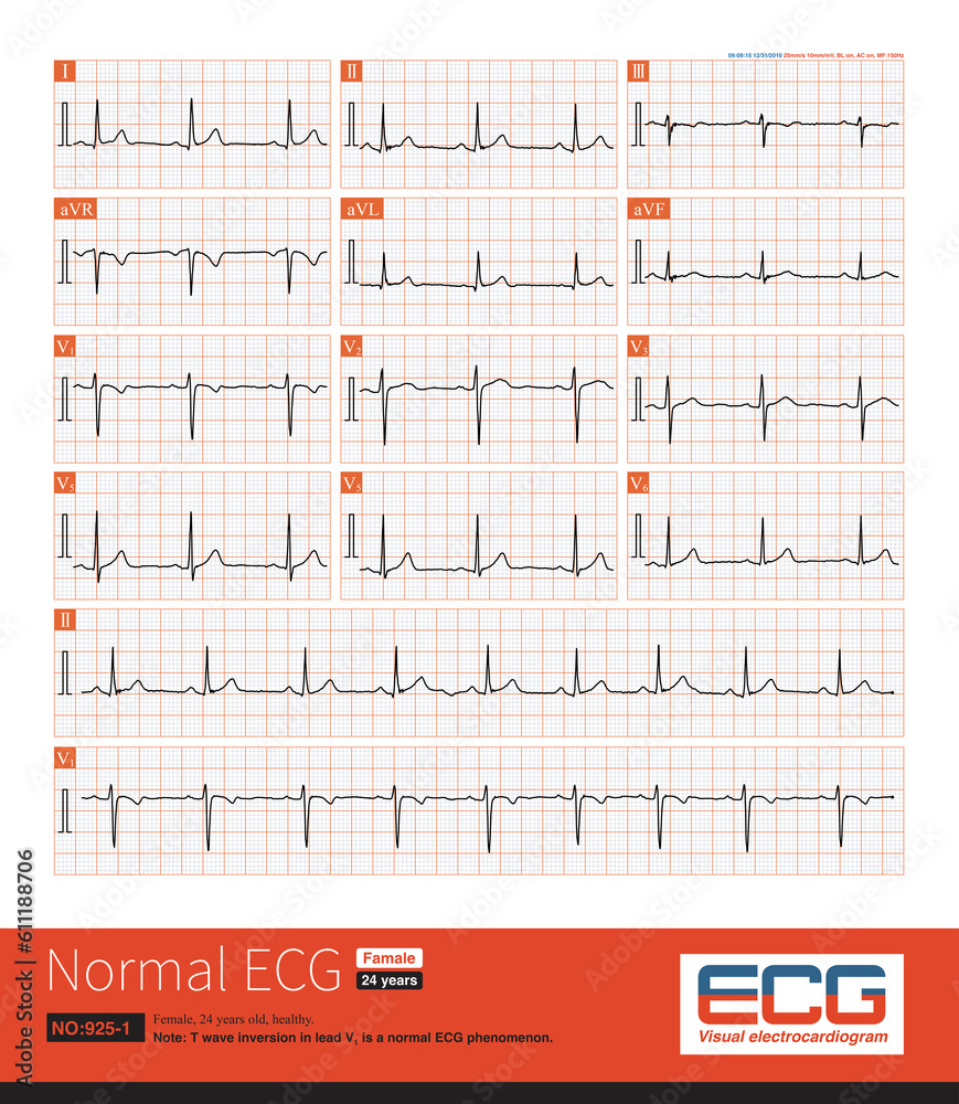 Female, 24 years old, healthy. Outpatient physical examination ECG ...