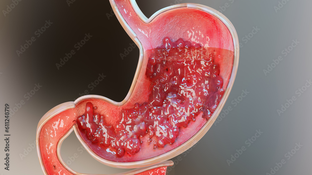 Ilustración de Stock Stomach cancer. stages tumor growth in digestive ...
