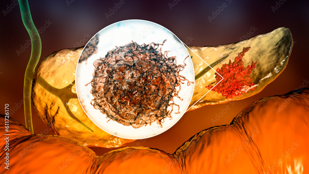 Pancreatic cancer, tumor of pancreas with close-up view of cancer cells ...