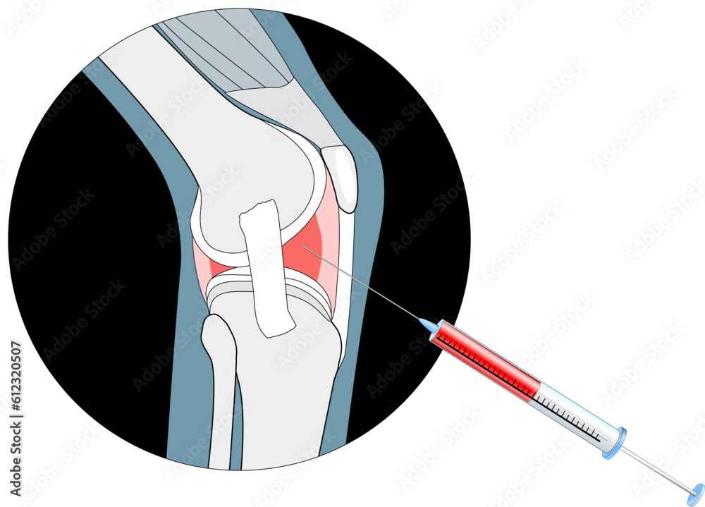 injection into the painful joint Stock Vector | Adobe Stock