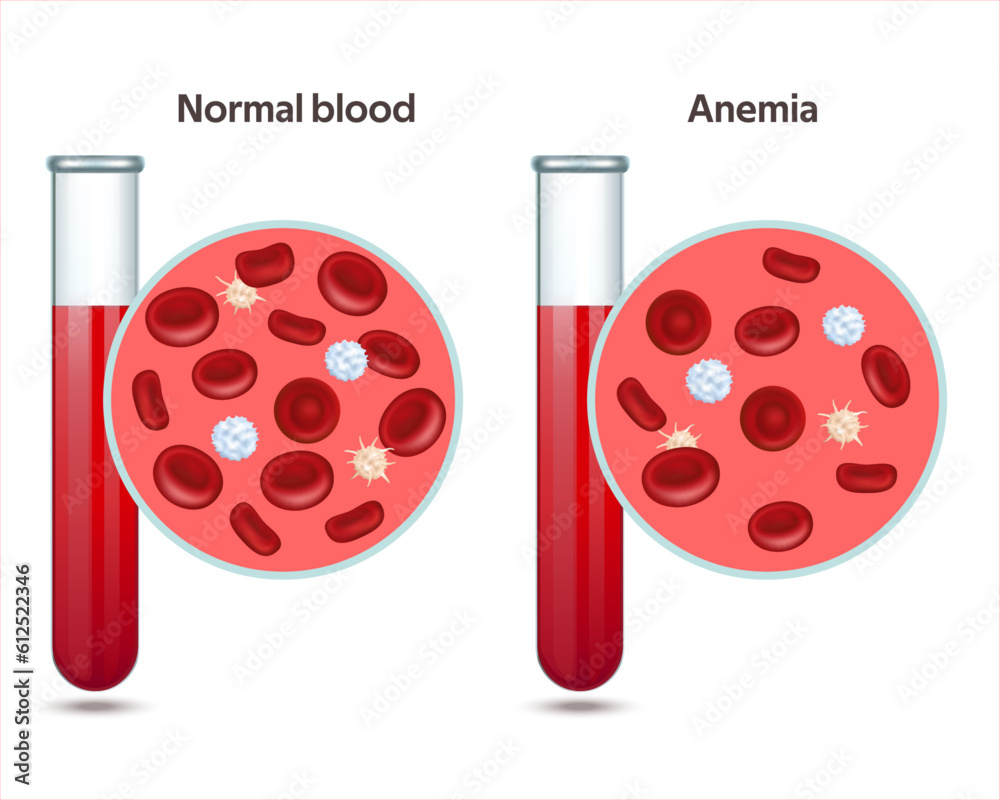 Two test tubes with normal blood and specimen with anemia disease ...