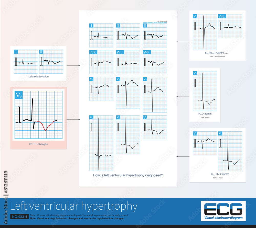 Ilustrace Common ECG changes in left ventricular hypertrophy include ...