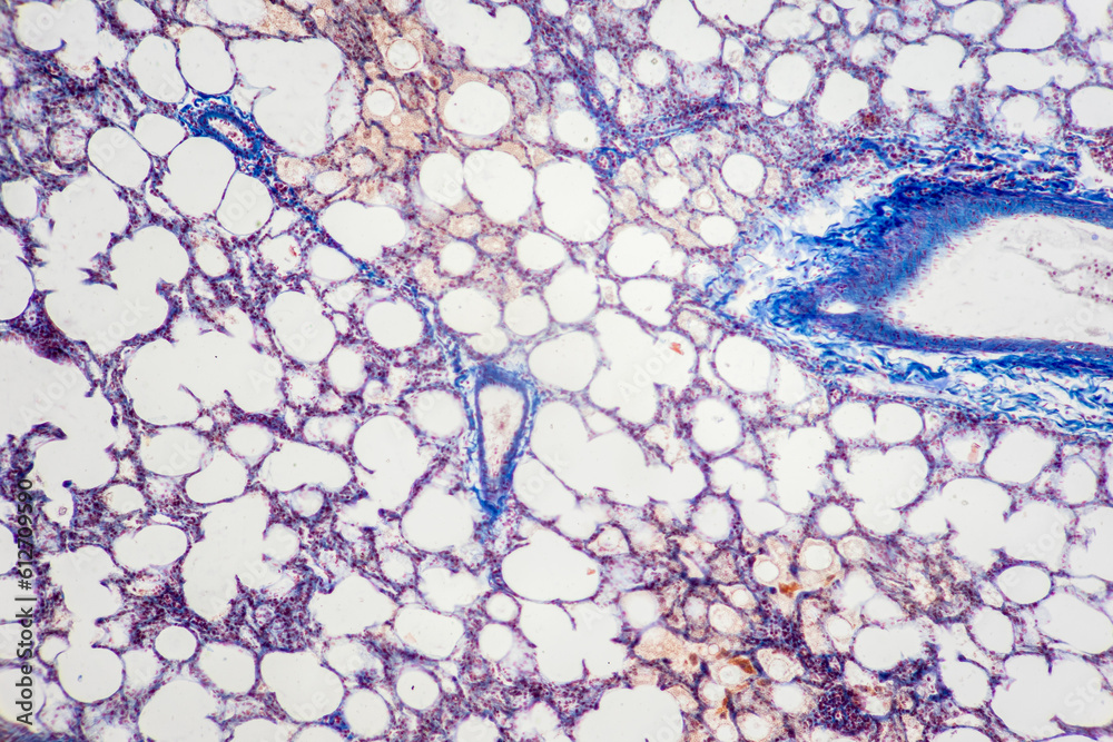 Foto de Stock Human lung pathology under light microscope, The lungs is ...