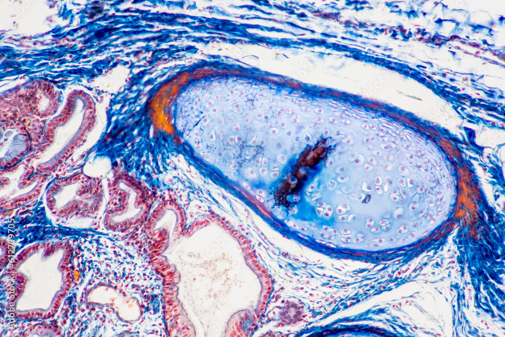 Foto de Stock Human lung pathology under light microscope, The lungs is ...