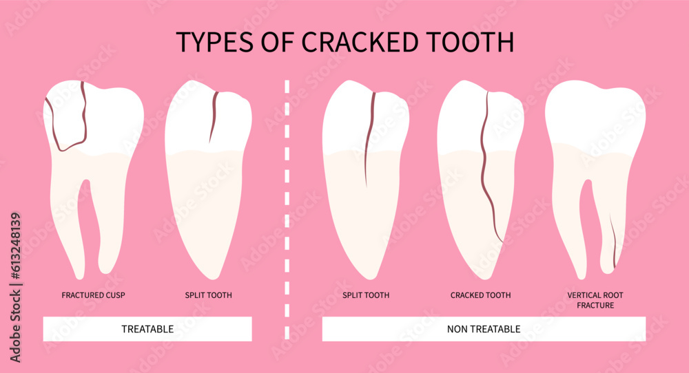 Fracture and grinding pain toothache syndrome teeth crack broken Bad ...