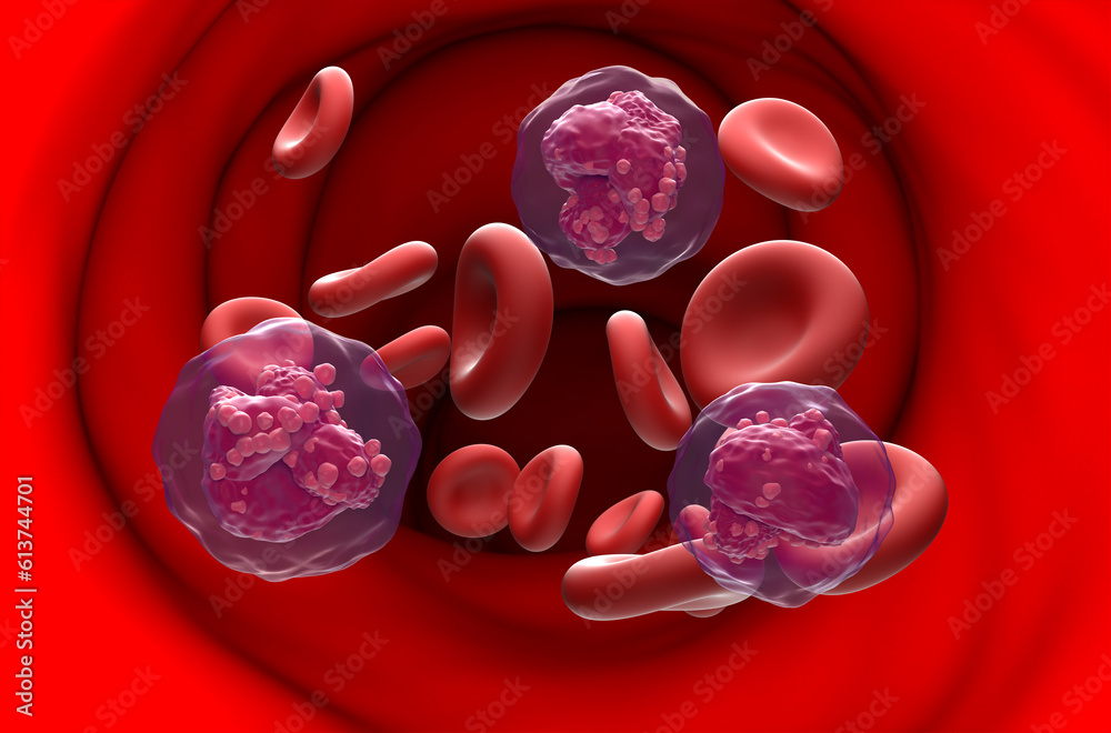 Acute lymphoblastic leukemia (ALL) cancer cell in blood flow - section ...