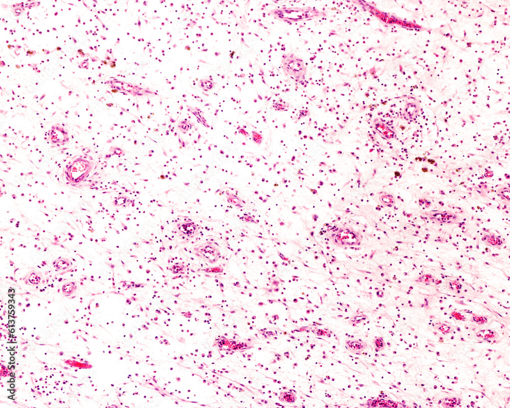 Loose connective tissue. Chronic inflammation Stock Illustration ...
