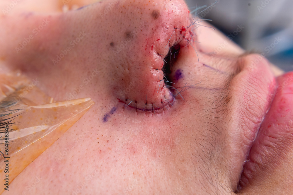 Closeup view of a female patient's nose right after surgery. Numerous ...