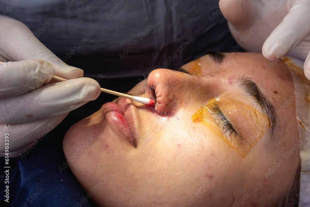 A cosmetic surgeon cleans the wound and incision sites of a female ...