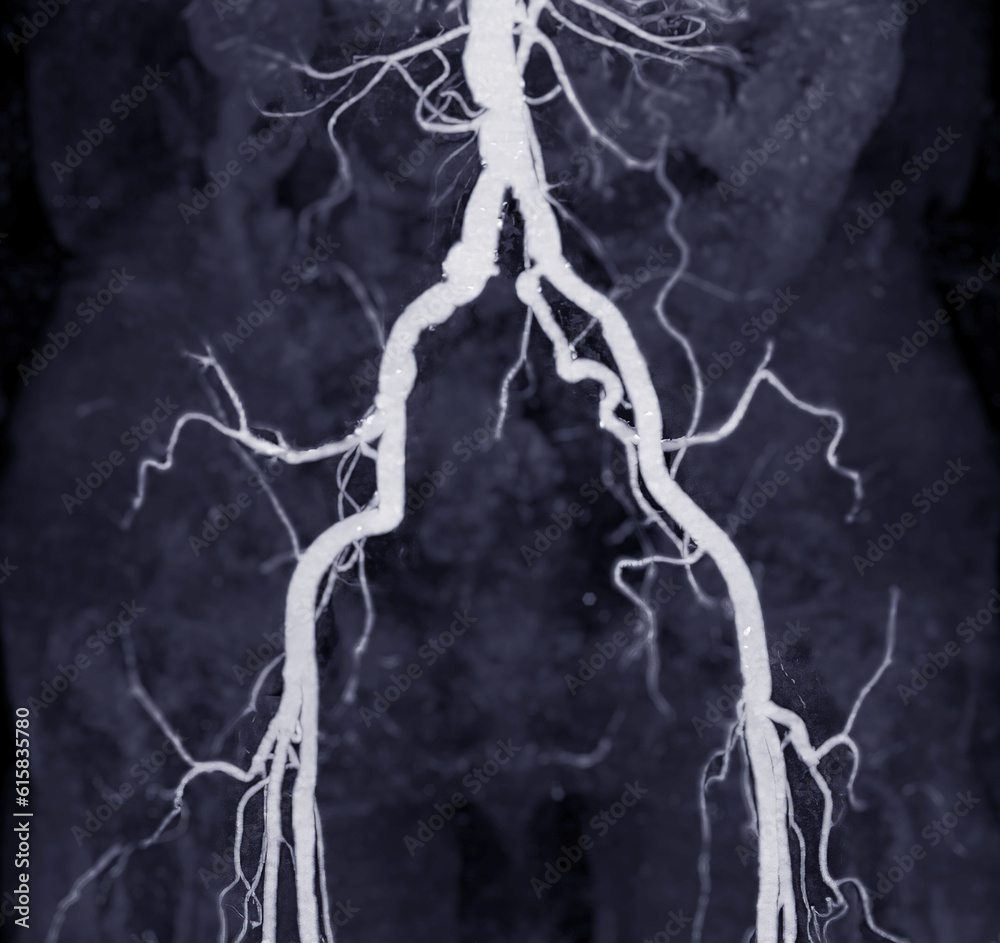 CTA femoral artery run off image of femoral artery for diagnostic Acute ...
