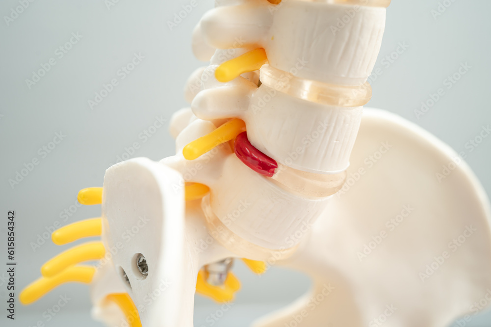 Lumbar spine displaced herniated disc fragment, spinal nerve and bone ...