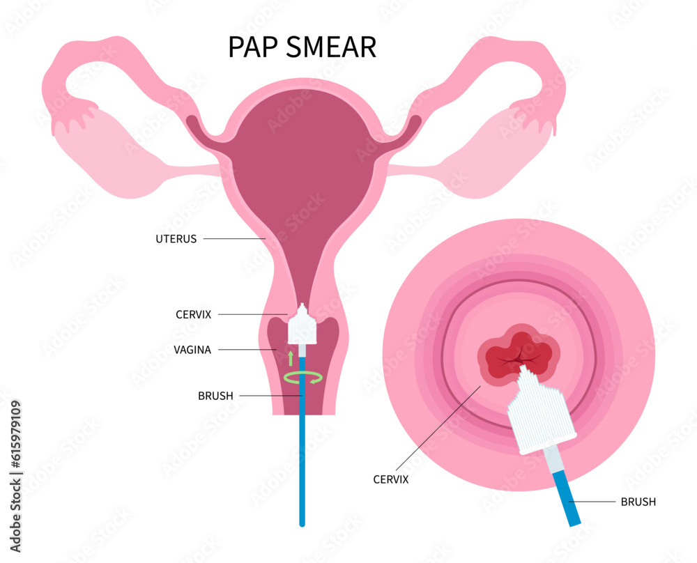 Pap Smear Test Procedure The Cervix Cancer Examine In Women Female And
