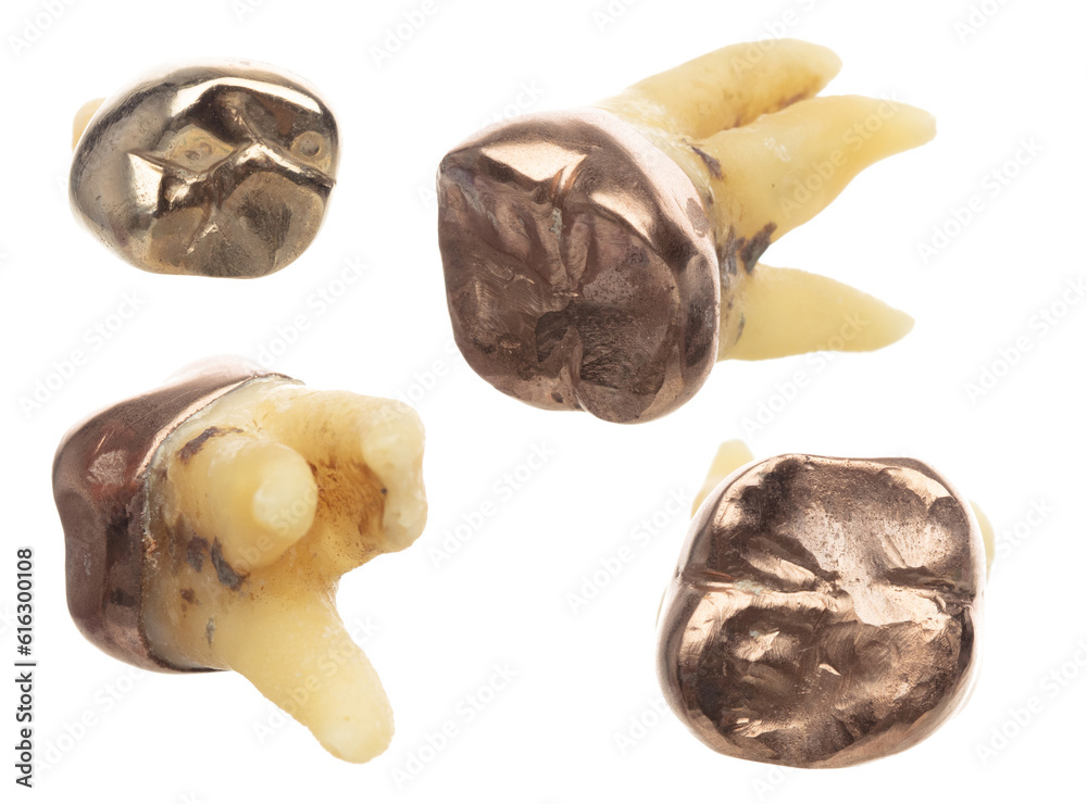 Pulled Molar Tooth with gold crown to show many angle, advanced caries ...
