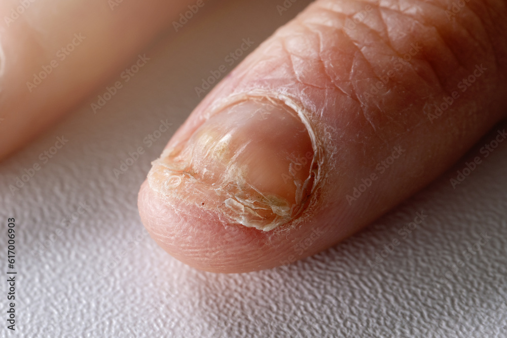 fungal infection. nail fungus candida on hand fingernail Stock Photo ...