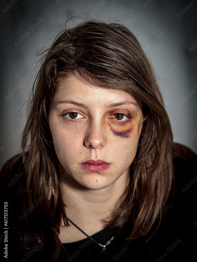 black-and-blue eye of a woman victim of domestic violence and abuse ...