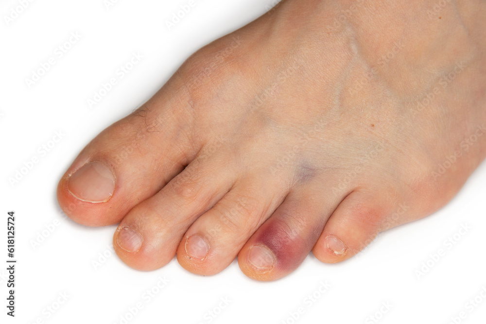 Close up of a broken toe - a common injury that's most often caused by ...
