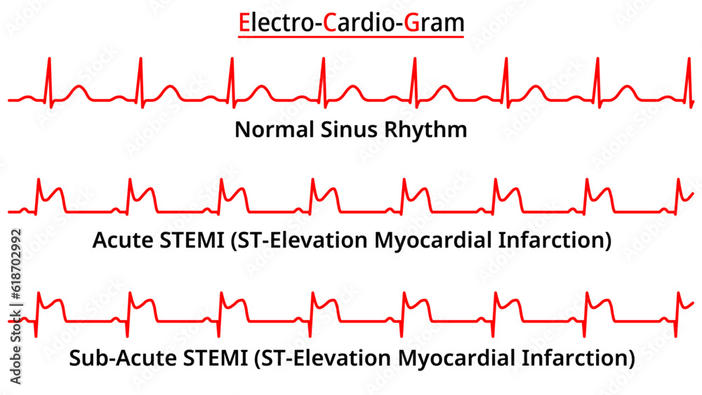 Set of ECG Common Abnormalities - Acute - SubAcute STEMI (ST-Elevation Myocardial Infarction ...