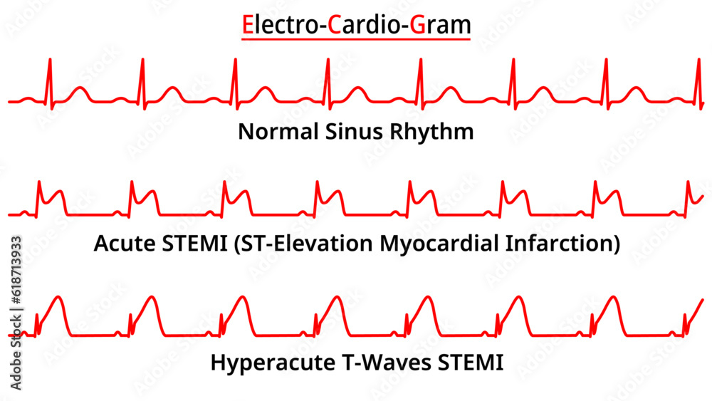 Set of ECG Common Abnormalities - Acute - Hyperacute STEMI (ST ... Set of ECG Common Abnormalities - Acute - Hyperacute STEMI (ST ...