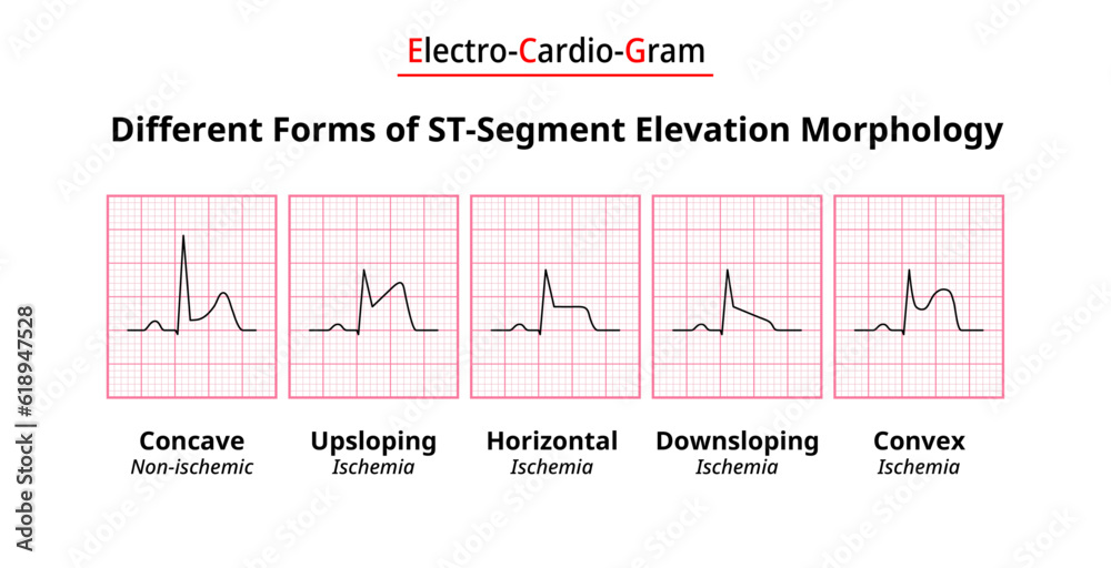 Different Forms of ST-Segment Elevation Morphology - ECG Ischemia - Non ...