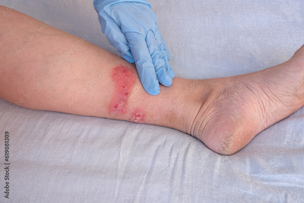 doctor treats large healing wound from on lower leg with scars of adult ...