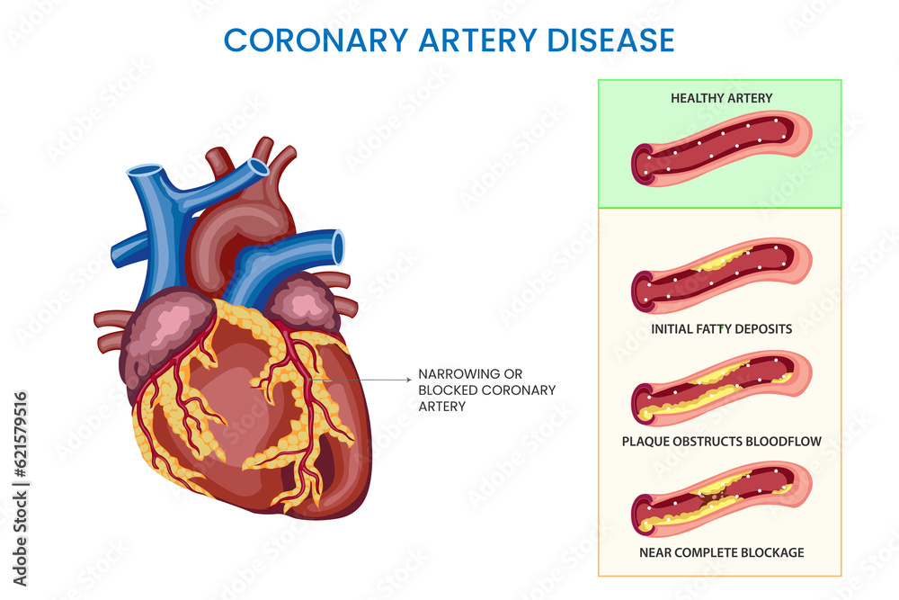 Coronary artery disease, Narrowed arteries, reduced blood flow ...