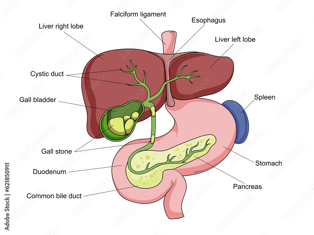 Gallstone structure stone gallbladder diagram schematic raster ...