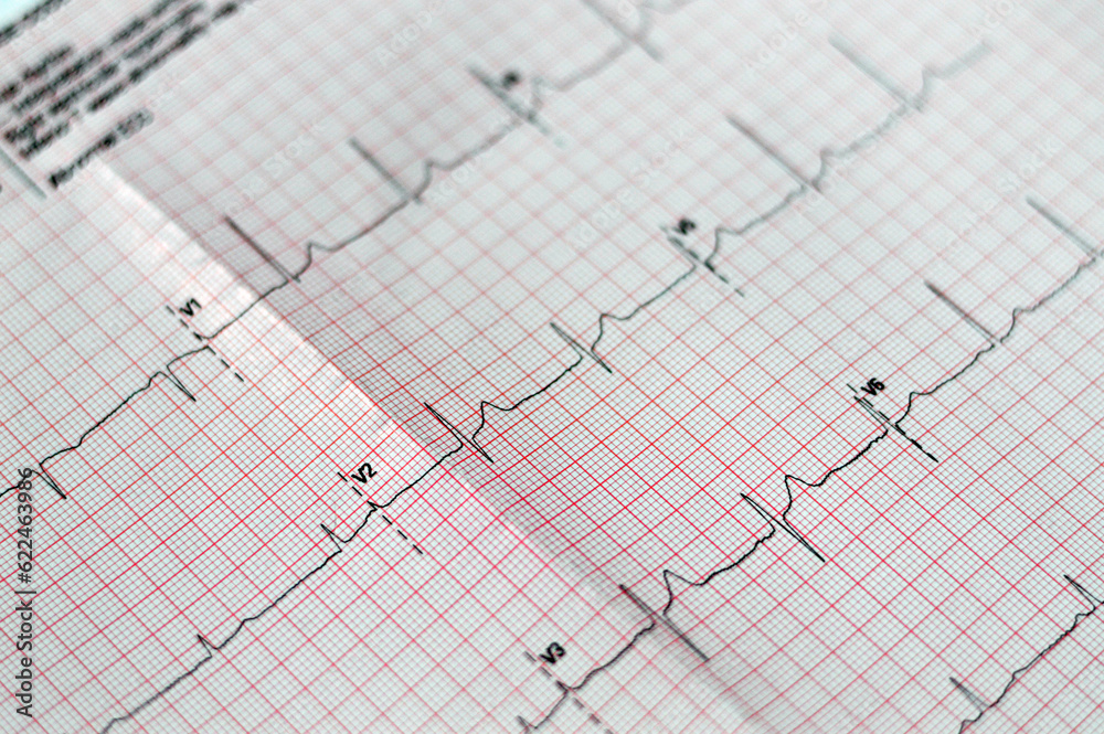 ECG ElectroCardioGraph paper that shows sinus rhythm abnormality of ...