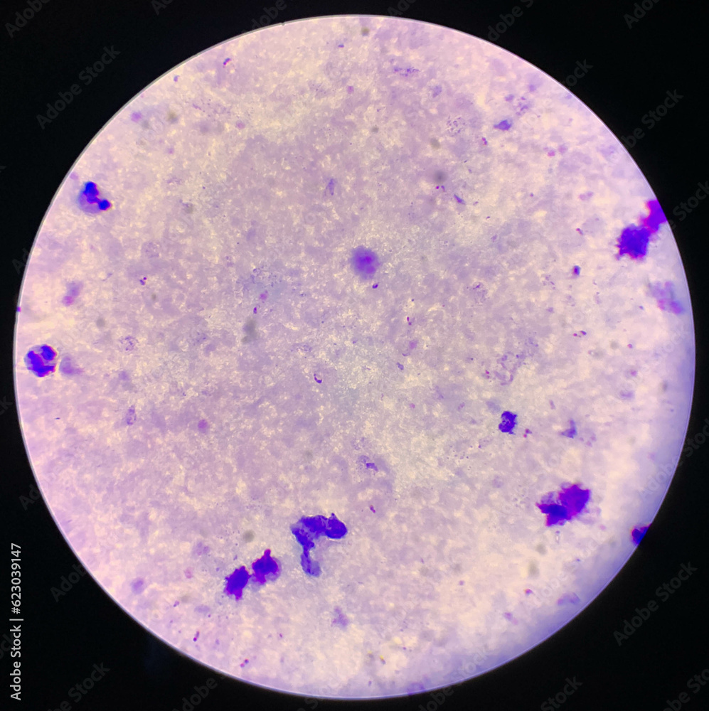 malaria parasite plasmodium falciparum on a thick blood smear reading ...