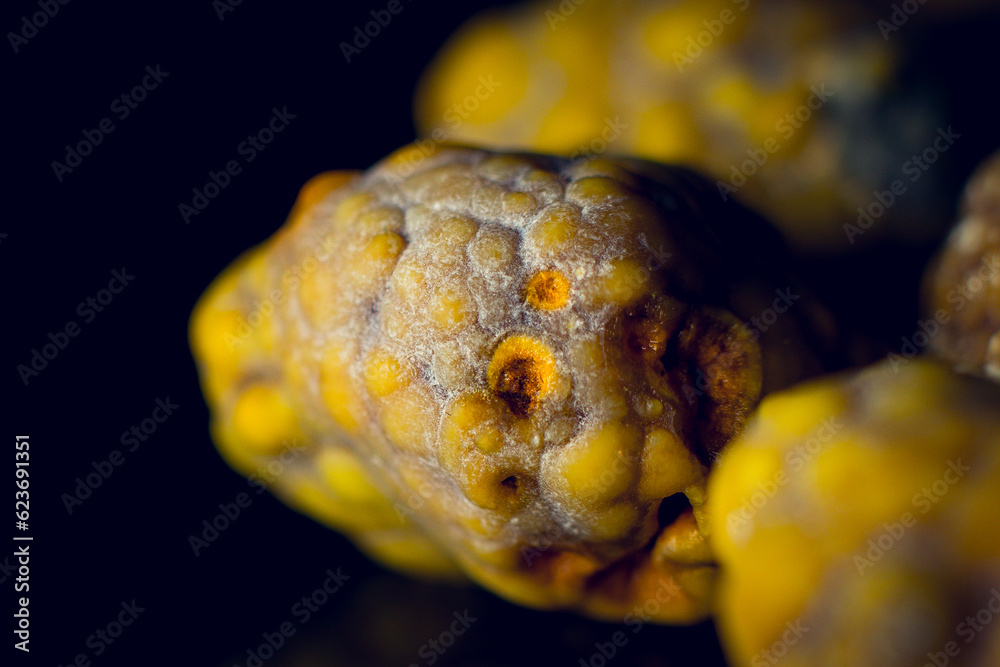 Foto de Stock Gallstones,multiple cholesterol stone in gallbladder with ...