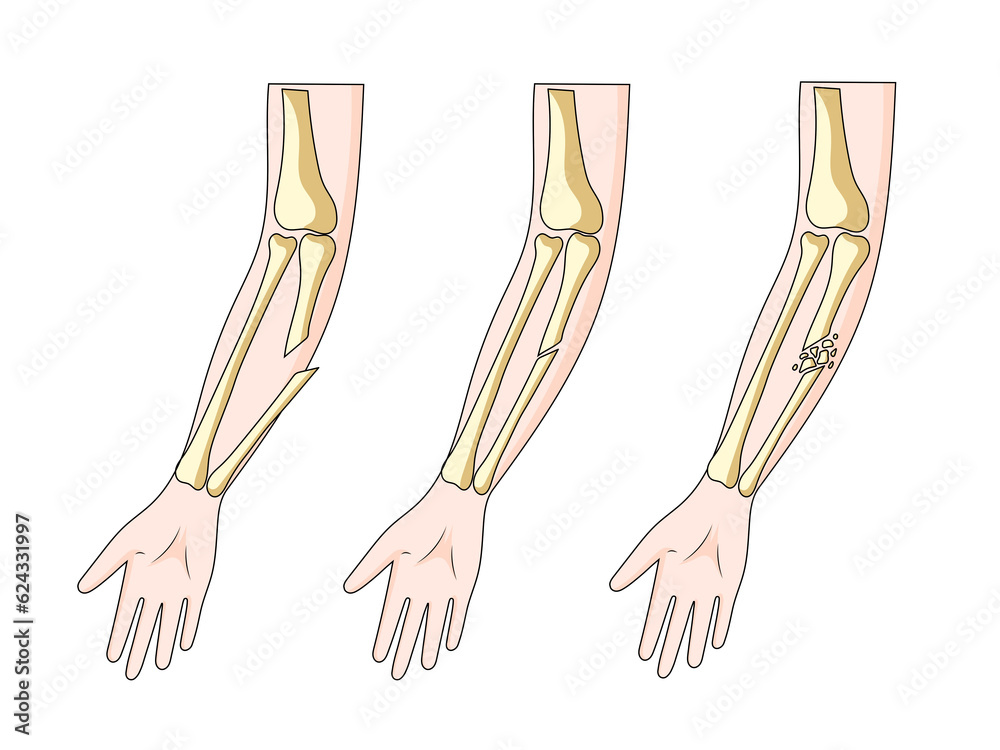 Types of hand bone fractures diagram schematic raster illustration ...