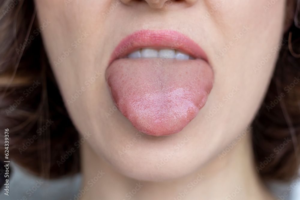 Close-up swelling of the tongue. Allergic reactions, Infections ...