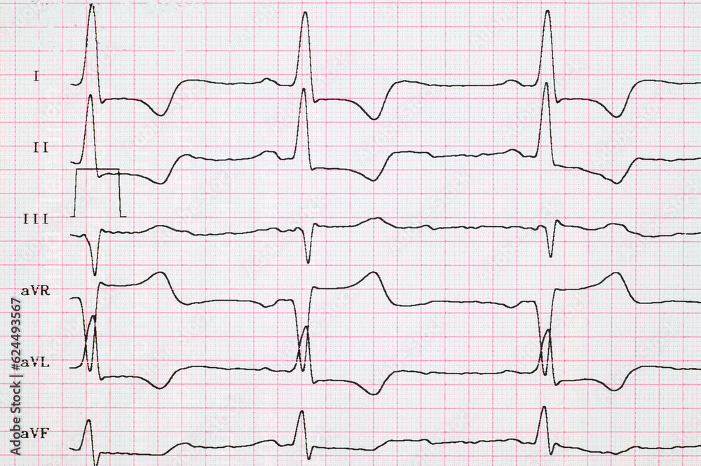 ECG. Myocardial infarction on ECG, subendocardial ischemia in standard and enhanced leads ...