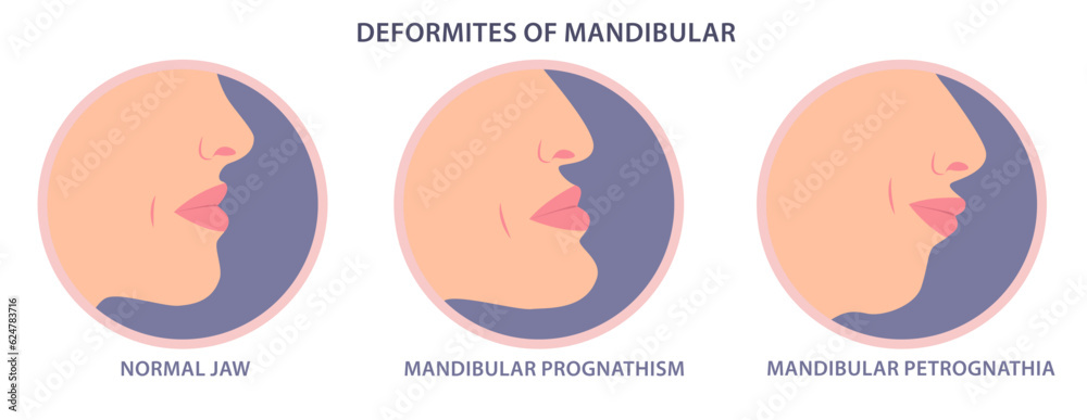 Deformities of mandibular vector illustration. Mandibular deficiency ...