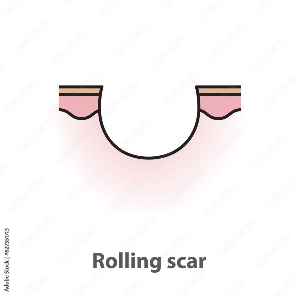 Rolling scar, atrophic scar, type of acne scar on skin surface with ...