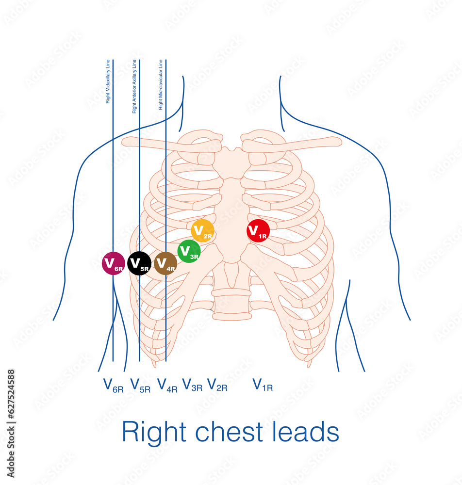 The electrodes of the conventional six chest leads are placed in the ...