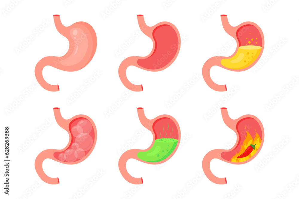Human stomach. Healthy and unhealthy, empty and full human stomach ...