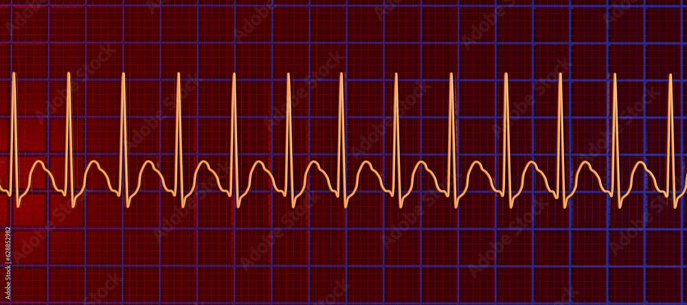 Electrocardiogram displaying supraventricular tachycardia, 3D ...