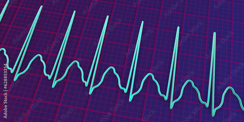 Electrocardiogram displaying supraventricular tachycardia, 3D ...